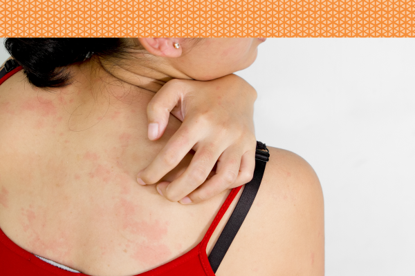 Brotoeja: Saiba mais sobre as causas e sintomas - Dermaweb